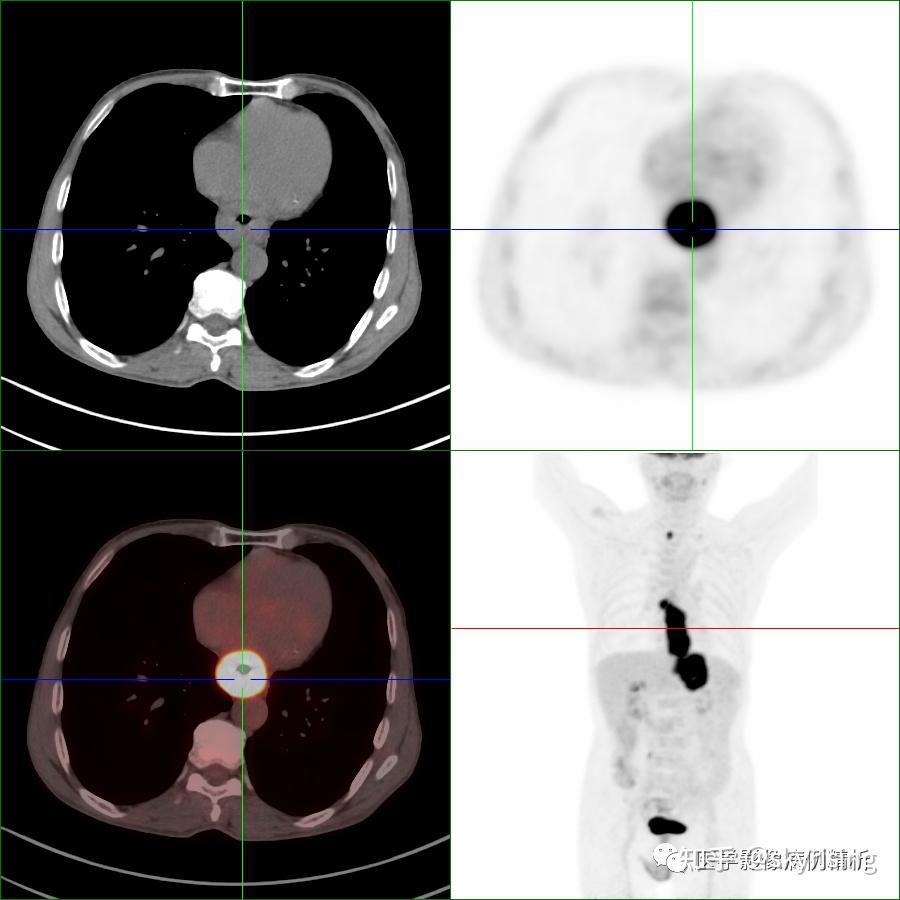 一文通读解析PET-CT检查所有注意事项、放射性危害及典型教学病例一例 - 知乎