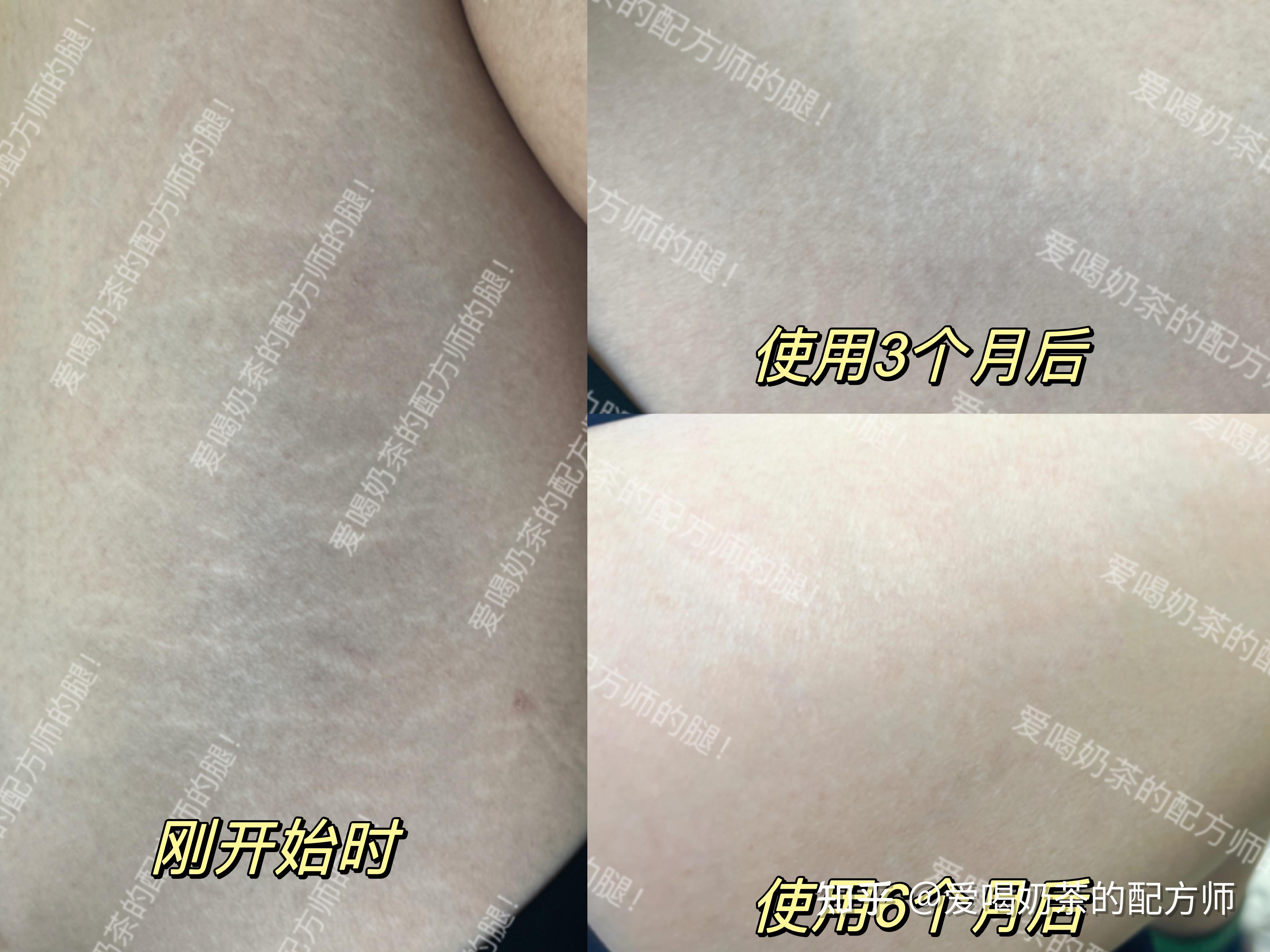 长了肥胖纹很自卑怎么办?为什么用了淡纹产品,肥胖纹还是淡化不掉?警惕 不是所有的肥胖纹产品都有用! 知乎