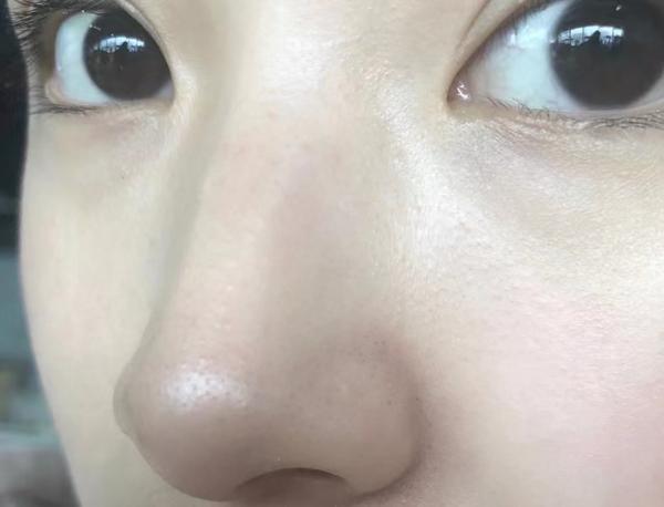 如何去除脸上的黑头粉刺？ 知乎