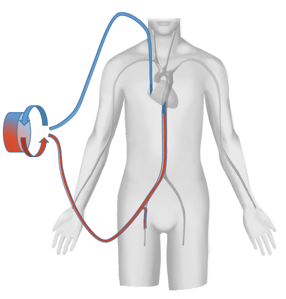 ECMO基础知识，最全总结！ - 知乎