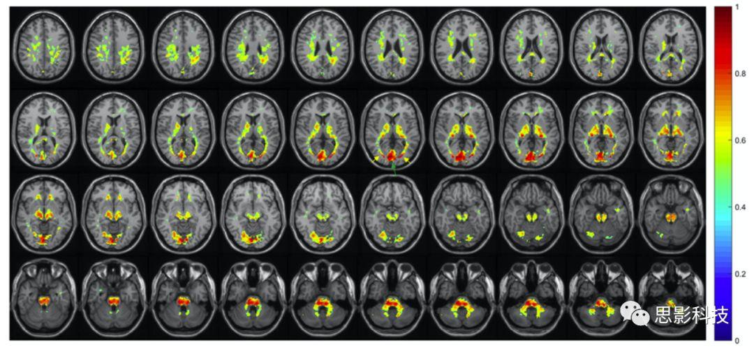Magnetic Resonance Imaging:白质fMRI及静息态功能连接 - 知乎