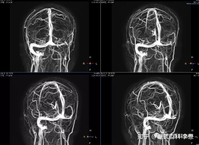 颅脑静脉MRV规范化扫描及临床应用 - 知乎