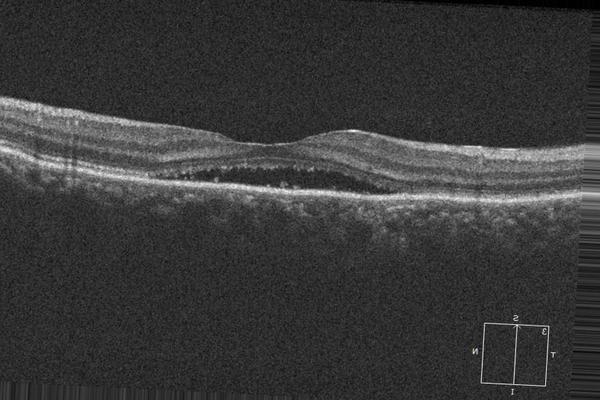 Retinal OCT-C8 数据集介绍 - 知乎