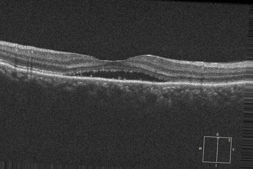 Retinal OCT-C8 数据集介绍 - 知乎