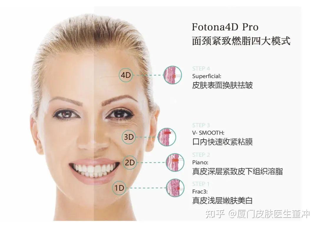 厦门欧洲之星Fotona4D PRO ：绝不是热玛吉平替！ - 知乎