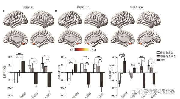 封面文章：伴自杀意念抑郁症患者半球水平功能连接改变的fMRI研究 - 知乎