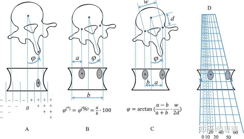 为什么侧弯好转，脊椎旋转（弯腰一边隆起）却没变化？ - 知乎