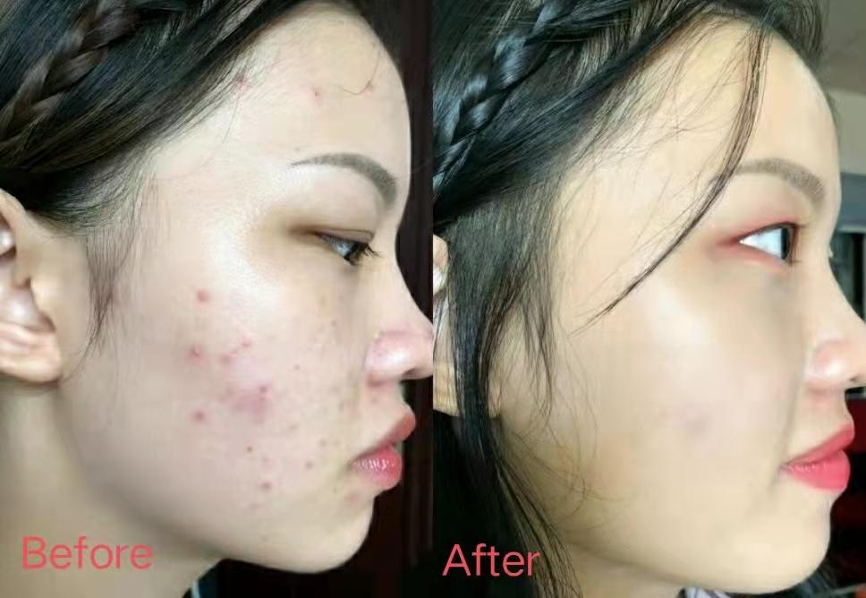 光子嫩肤避坑指南|IPL、AOPT、DPL怎么选？哪些人适合做都知道吗？ - 知乎