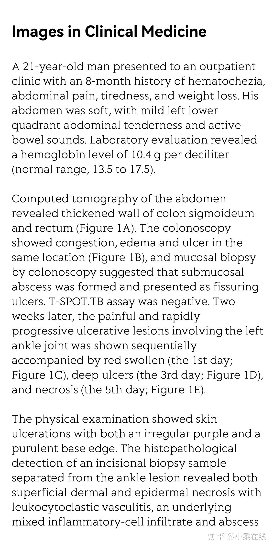 Pyoderma gangrenosum in ulcerative colitis - 知乎