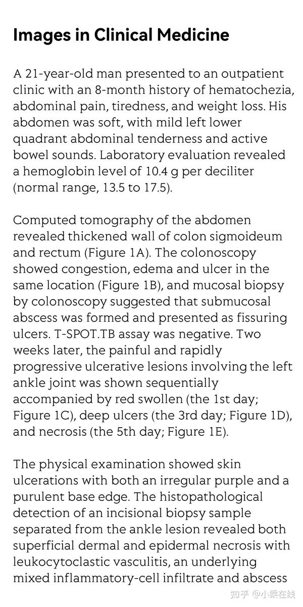 Pyoderma gangrenosum in ulcerative colitis - 知乎