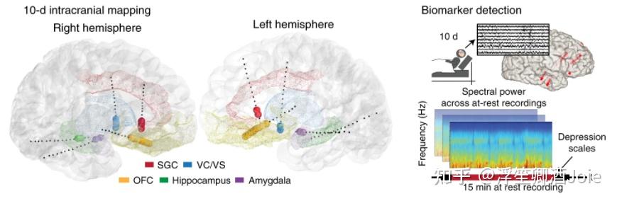 【THERAPY】Closed-loop neuromodulation in an individual with treatment-resistant depression - 知乎