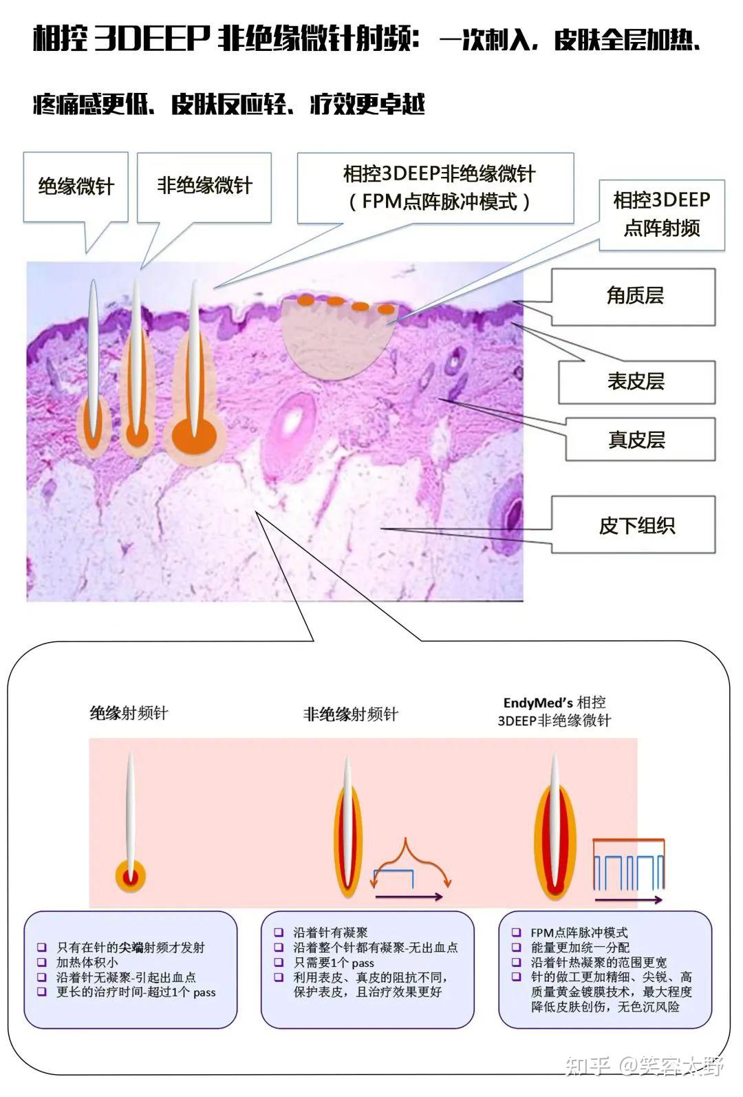美迪迈EndyMed pro 3Deep 真的能够媲美热玛吉？ - 知乎
