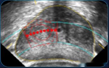 150亿细分赛道！专注于前列腺肿瘤消融的海扶刀公司Sonablate - 知乎