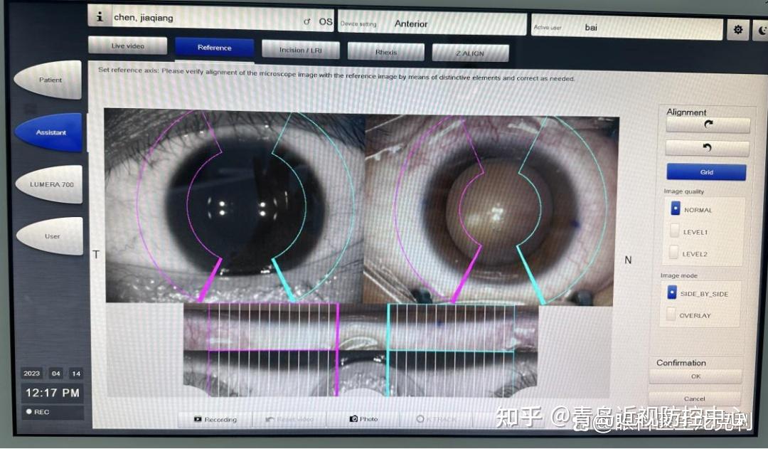 术中导航引导、实时OCT成像——助力ICL精准植入 - 知乎