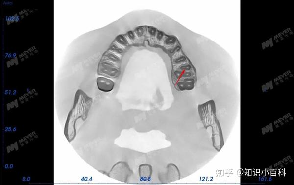 美亚口腔CBCT，让MB2无所遁形！ - 知乎