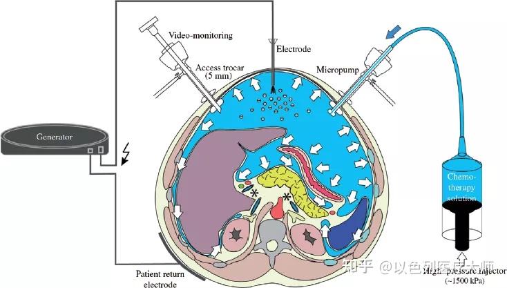 舍巴医学中心癌症治疗突破性技术：加压腹腔气雾剂化疗PIPAC，治疗腹腔内肿瘤转移，有效延长患者生命 - 知乎