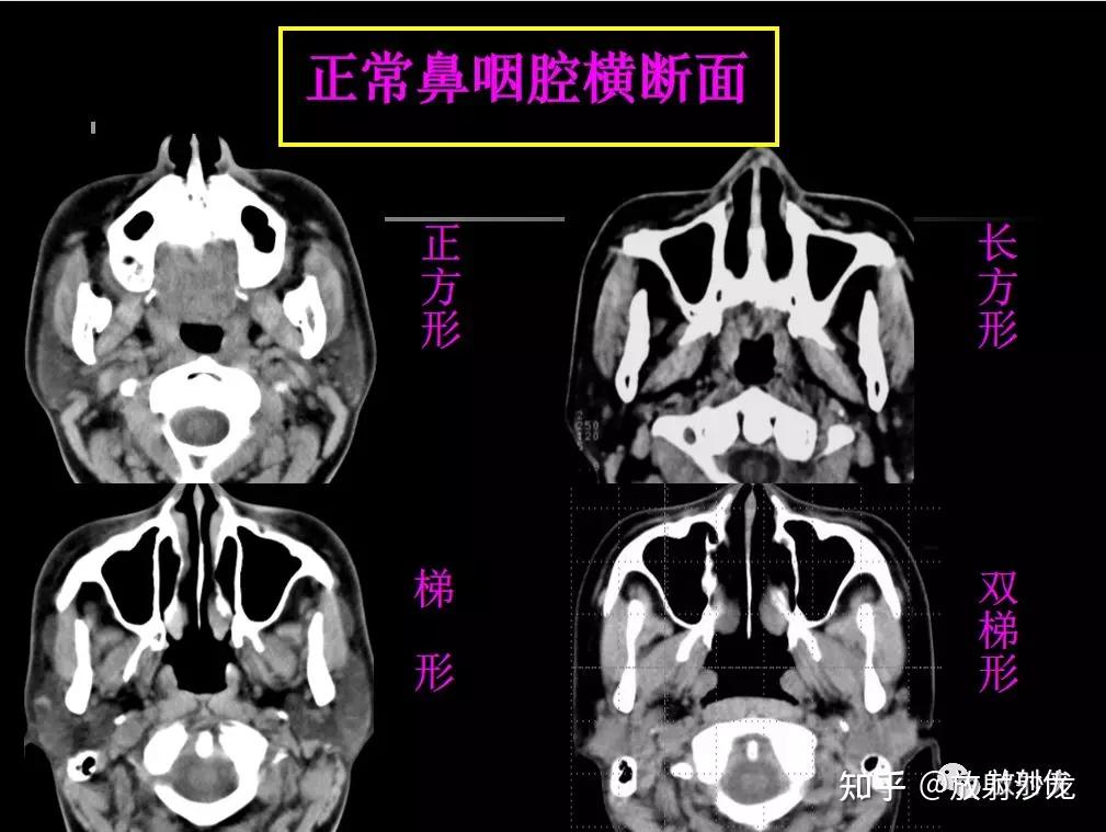 收藏必备 鼻咽部的ct详细解剖 知乎