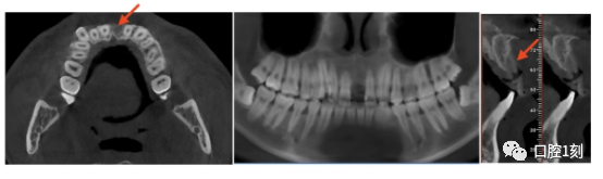 Sticky Bone在引导骨再生中的应用 - 知乎