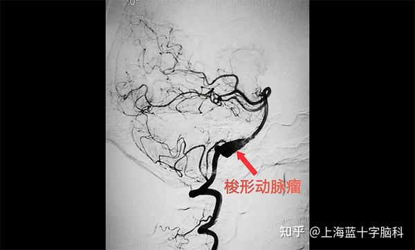 脑血管病做什么检查？专家解读：CTA、MRA、DSA - 知乎
