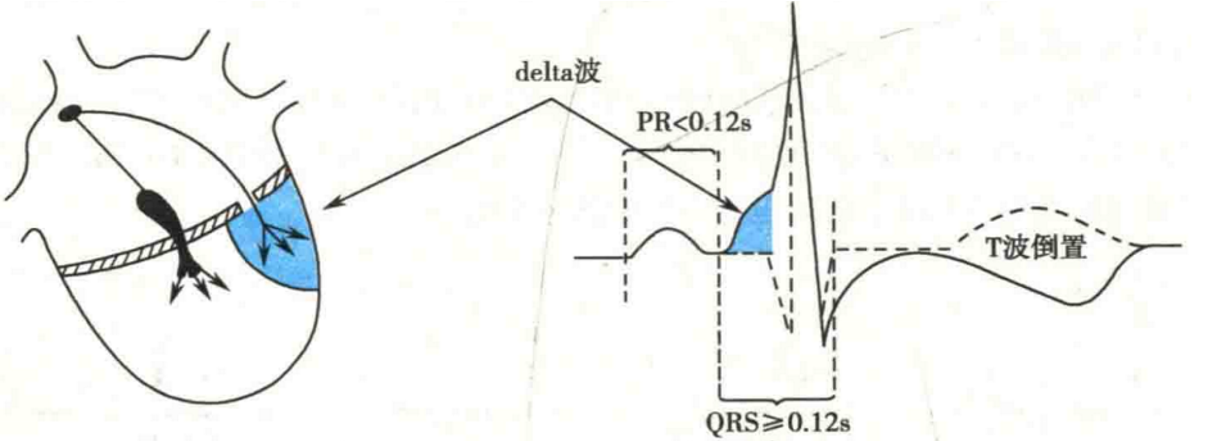 心律失常概述 - 知乎
