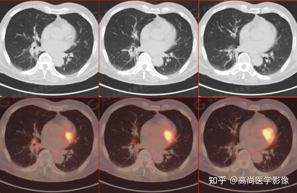 PET/CT病例：肺鳞癌5例【高尚医学影像】 - 知乎