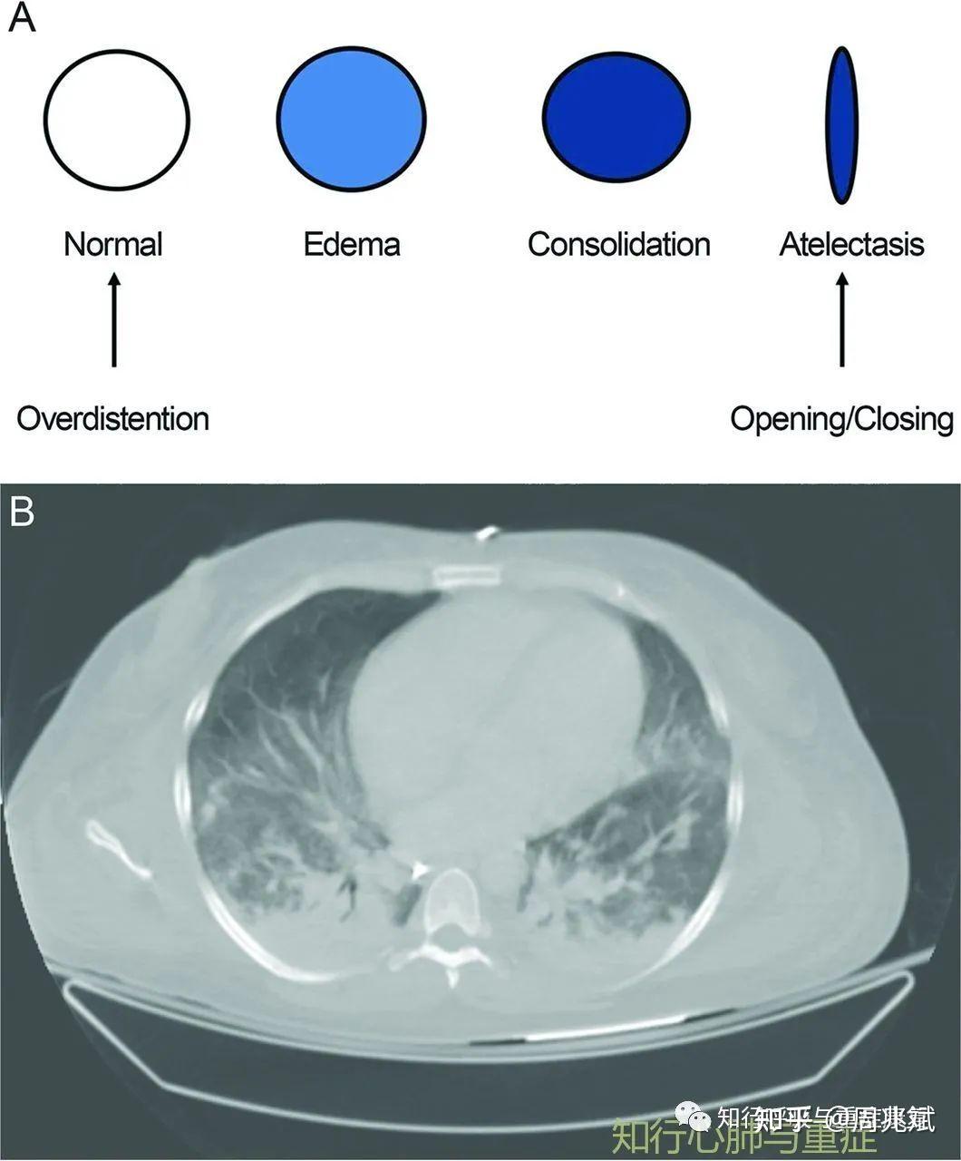 第149期 滴定PEEP的9个方法 - 知乎