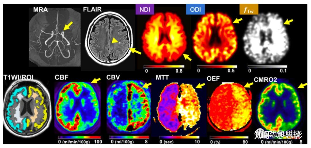 NODDI在临床研究中的应用 - 知乎