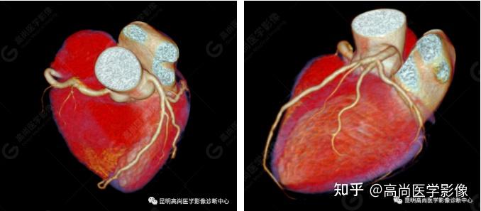 什么是CTA检查？哪些人需要做这个检查？ - 知乎