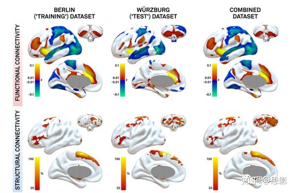 连通性可预测深部脑刺激（DBS）对帕金森的疗效 - 知乎
