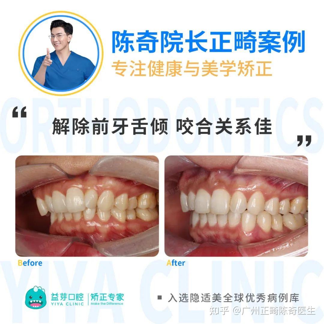 入选Invisalign Global Gallery | 成年人闭锁性深覆合+下巴后缩，2年隐形正畸咬合重建！ - 知乎