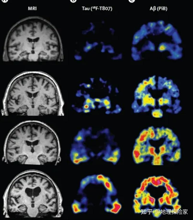 深度学习—各类疾病数据集大合集（附下载地址） - 知乎