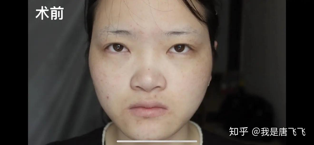 我去做超皮秒了，手术过程和30天恢复记录分享【整容】【医美】 知乎