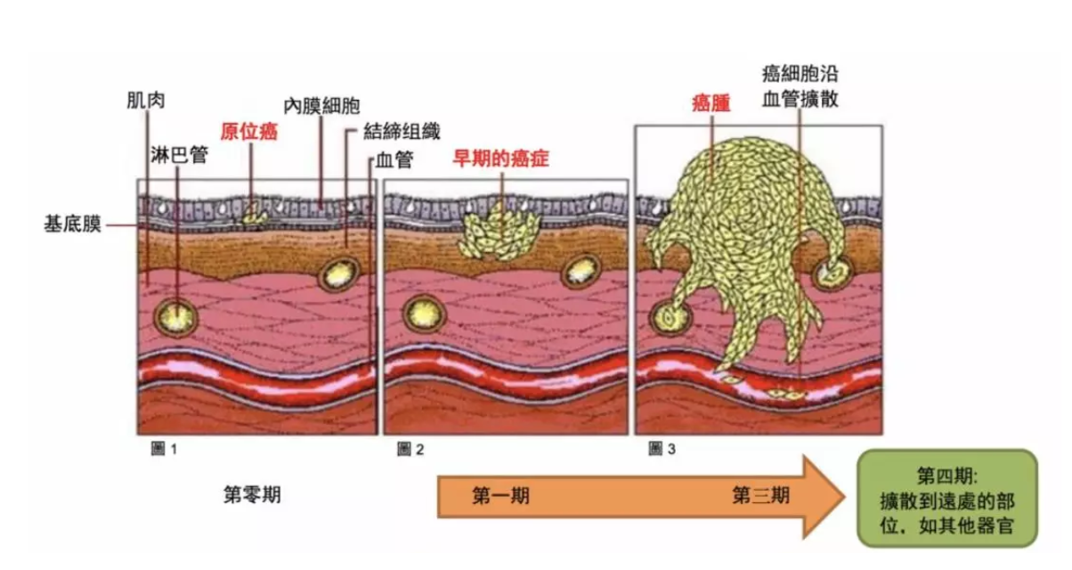 为什么乳腺结节看似 事小”,却买不了保险? 知乎