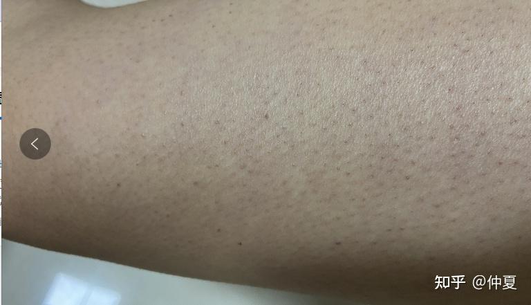 全身脱毛记录 知乎