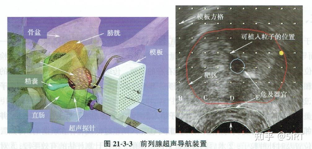 放射性粒子植入 知乎 6675