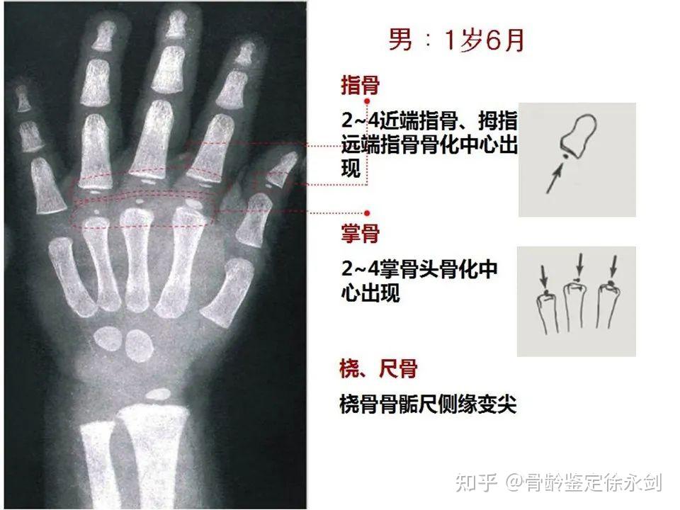 详解骨龄检测G-P骨龄图谱（男生版） - 知乎