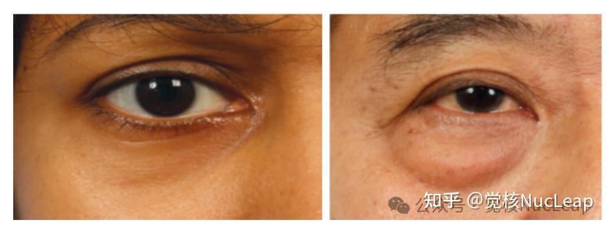 泪沟填充全面解析：从解剖层次、注射技法到风险规避，一篇讲透 - 知乎