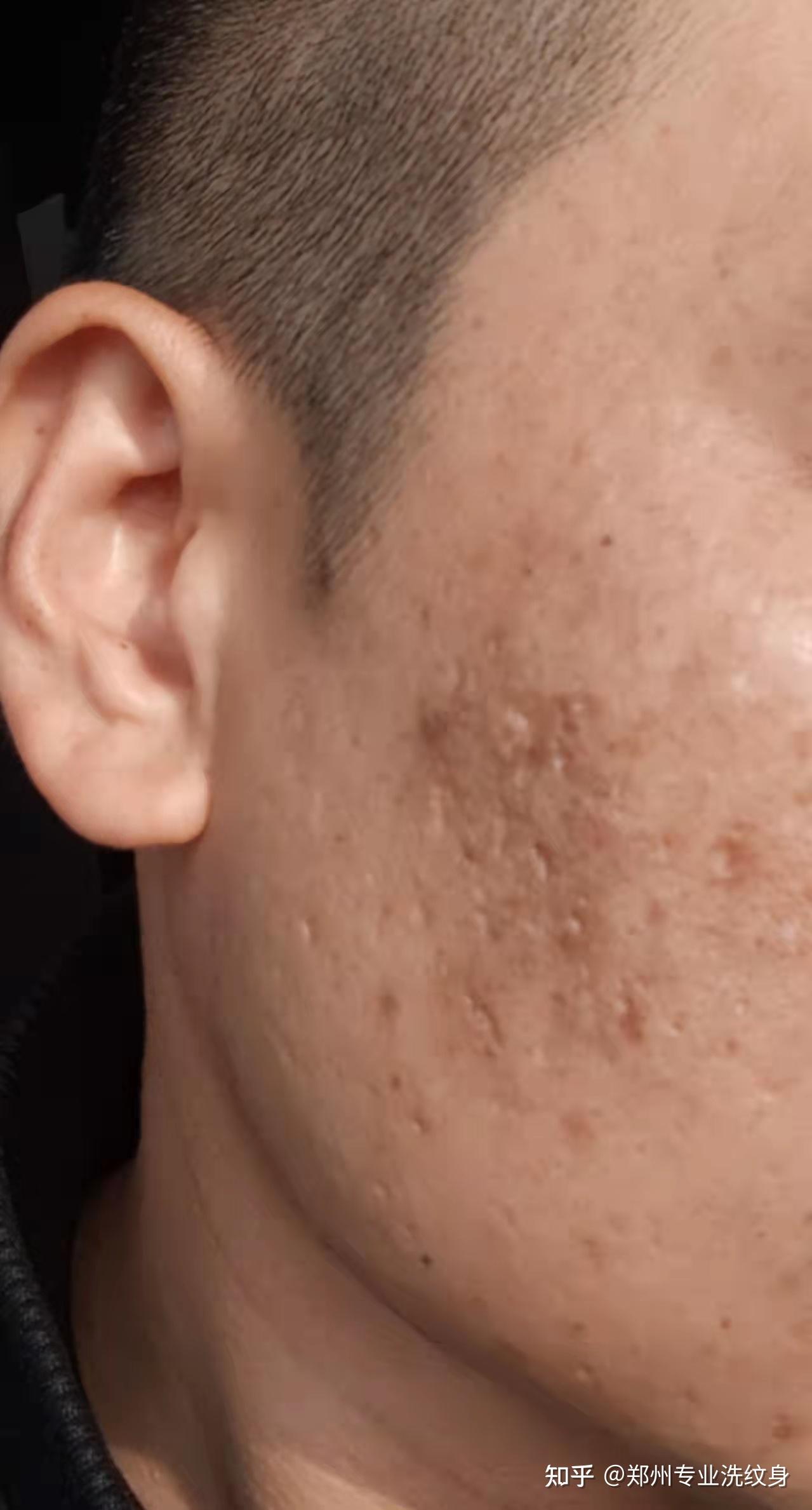 不走弯路修复痘坑的方法 - 知乎