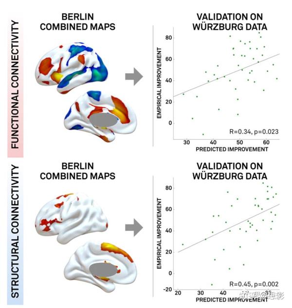 连通性可预测深部脑刺激（DBS）对帕金森的疗效 - 知乎
