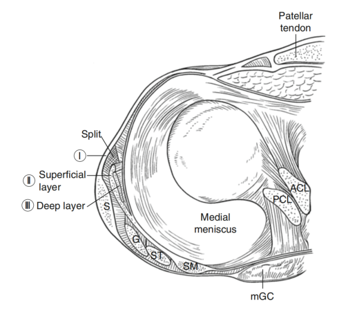 膝关节内侧副韧带（MCL）磁共振解剖要点 - 知乎