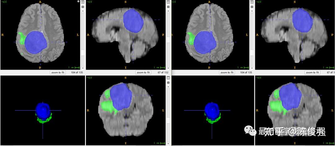 BraTS2023-MEN——BraTS2023颅内脑膜瘤分割挑战赛 - 知乎