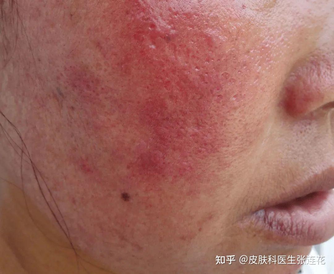 【赣州治疗皮炎医院】天呀!身上皮炎,罪魁祸首竟是手机 知乎