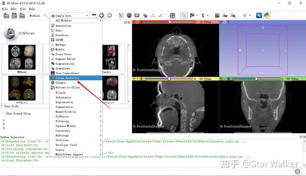 3D Slicer——选择感兴趣区，输出为DICOM序列 - 知乎