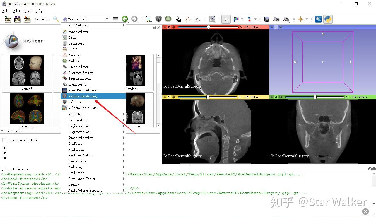 3D Slicer——选择感兴趣区，输出为DICOM序列 - 知乎