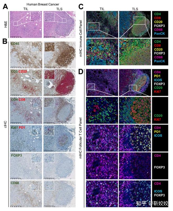 经典案例合集 | 多重免疫荧光在乳腺癌研究中的应用，从这几个角度入手！ - 知乎