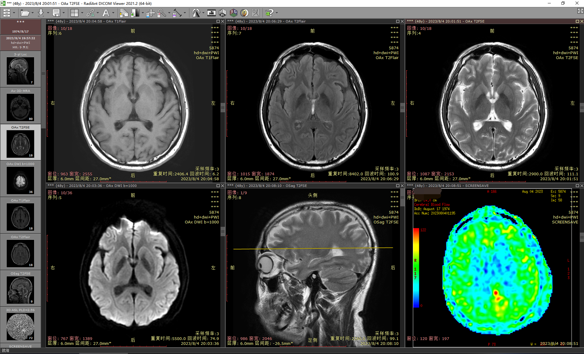 DICOM 图像浏览器和影像科研平台推荐（附 Radiant Viewer、3D Slicer 安装包） - 知乎