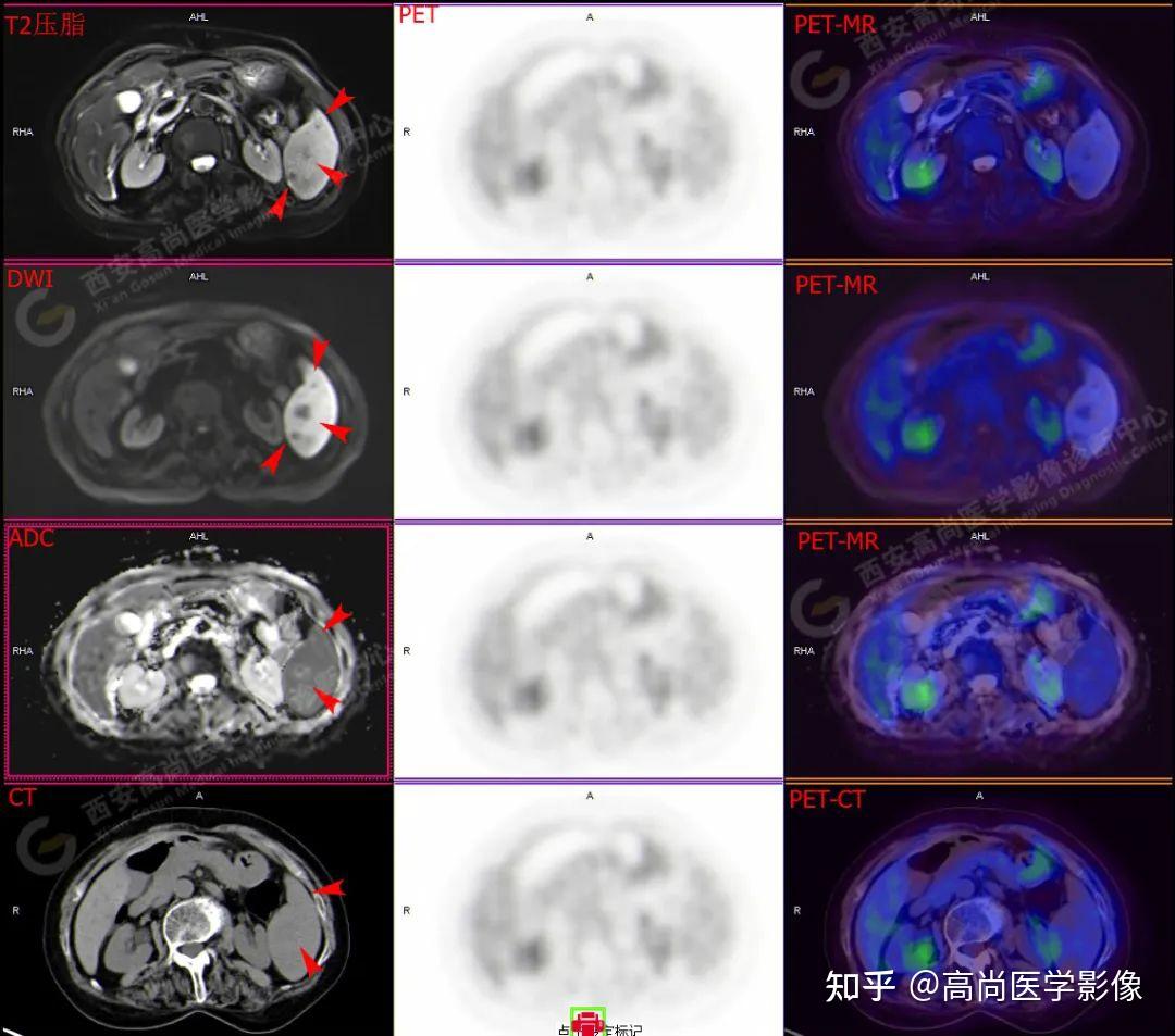 PET/CT-MR多模态病例：脾脏罕见良性肿瘤，诊断难度大导致误切除1例【高尚医学影像】 - 知乎