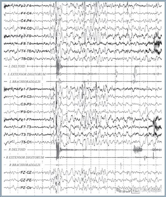 新版癫痫循证科普系列||肌阵挛-失张力癫痫临床及EEG表现 - 知乎