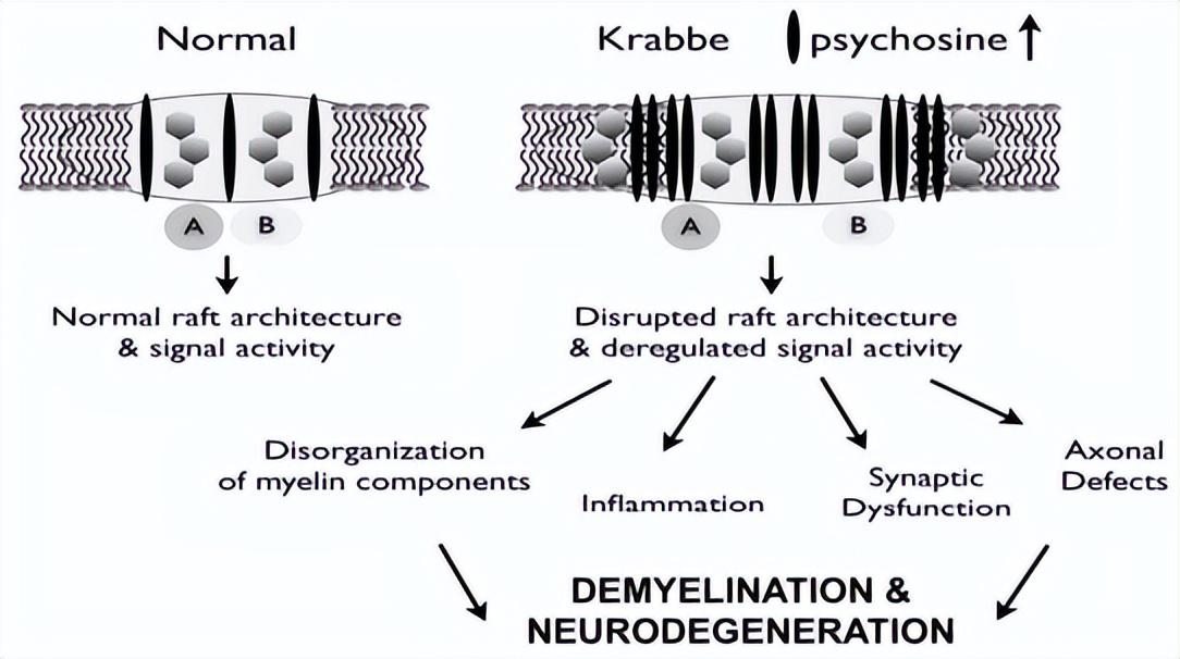案例分享 | 罕见病基因诊断——Krabbe病 - 知乎