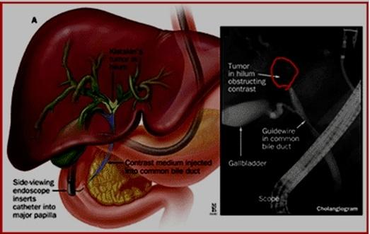 第二十四章 胆道疾病病人的护理 - 知乎